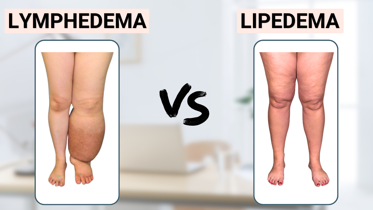 Cancer Rehab PT — Lipedema vs Lymphedema: What's the Difference & What ...