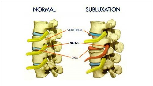 The Impact Subluxation Can Have On Your Body — Murphy Chiropractic ...