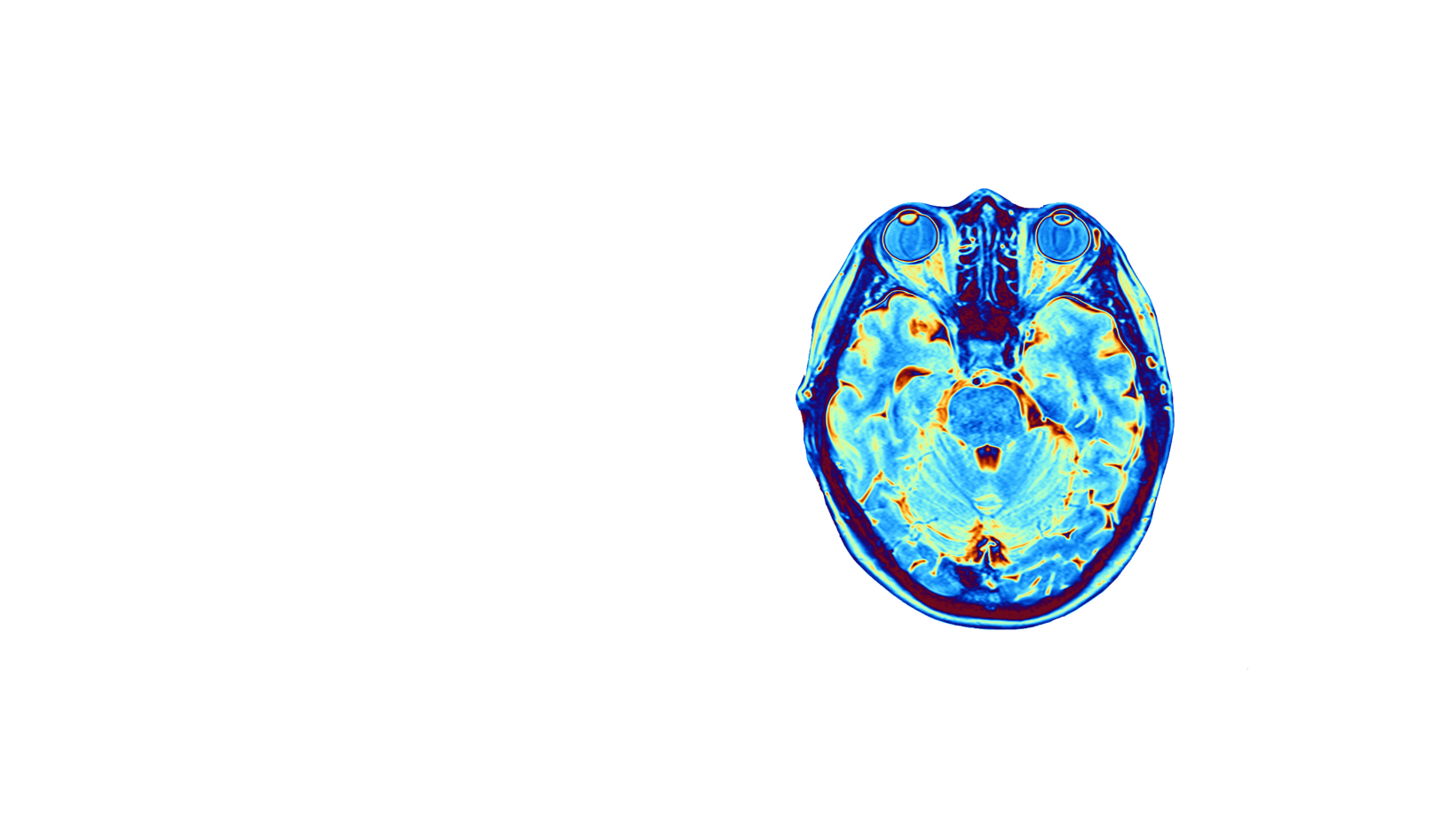 Concussion/TBI — EagleEye Performance Vision