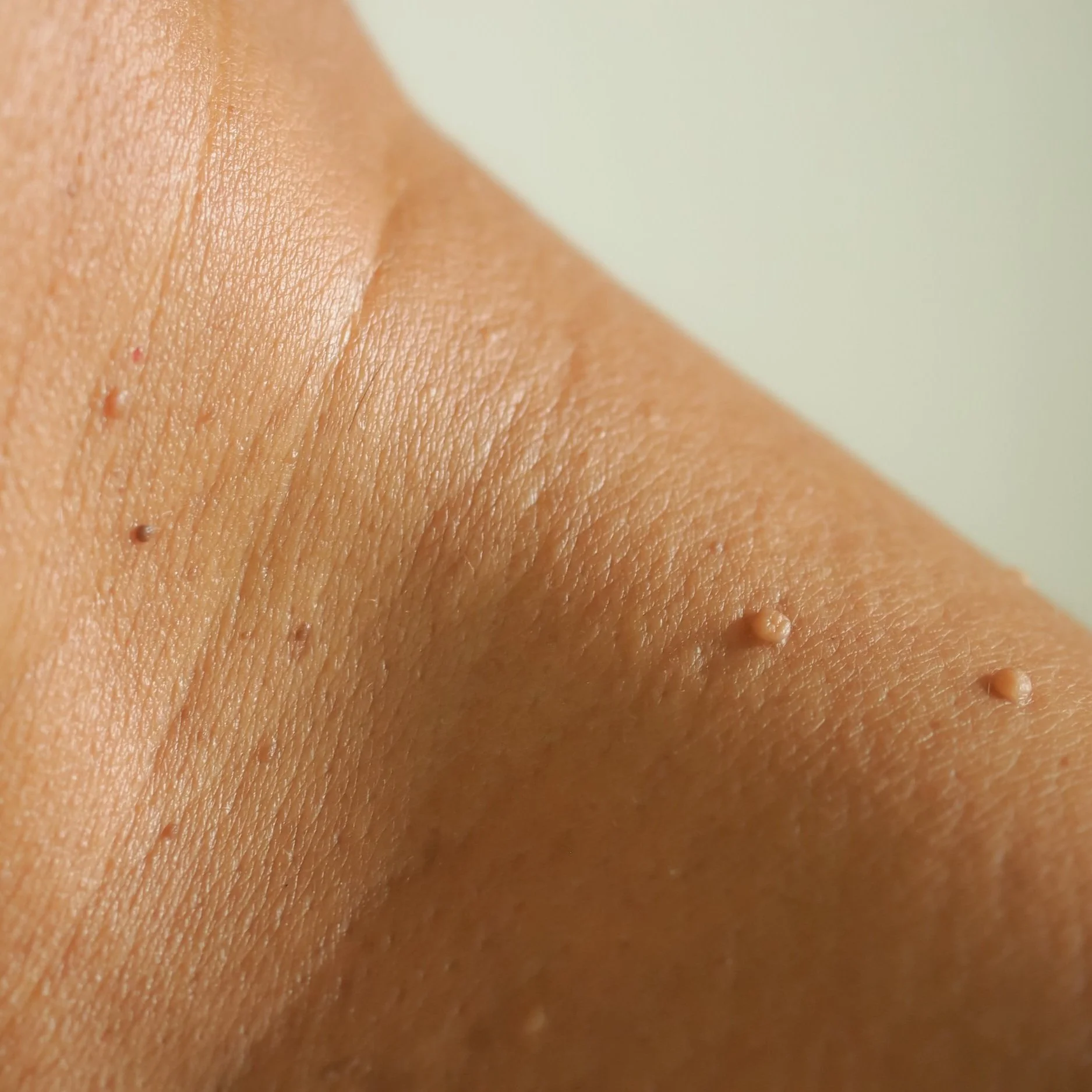 Skin Tag Removal/Vasculyse — The Spa 654 Club