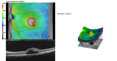 Do You Need an OCT Scan at Your Next Eye Exam?