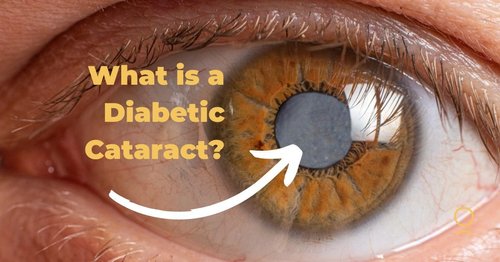 What is a Diabetic Cataract?