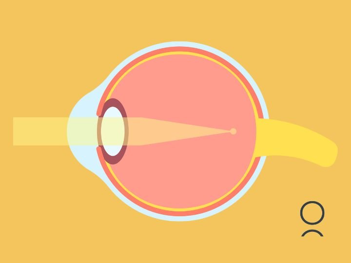 Myopia Control for Kids in Edmonton | Nearsightedness Treatment