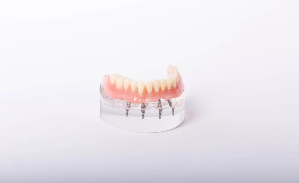 Implant Overdentures: The Game-Changer for Denture Wearers with Little ...