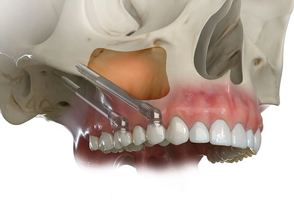 Zygomatic Implants: A Groundbreaking Solution for Complex Dental ...