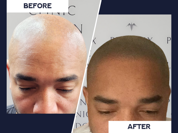 FAQs - Scalp Micropigmentation (SMP) — PHOENIX CLINIC LONDON
