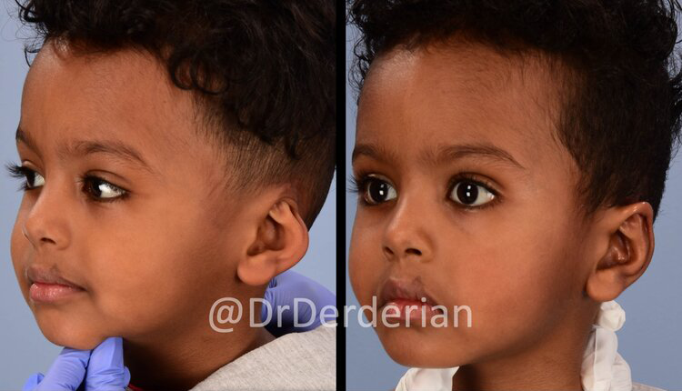 Cryptotia — Dr Derderian — Plastic and Reconstructive Surgery