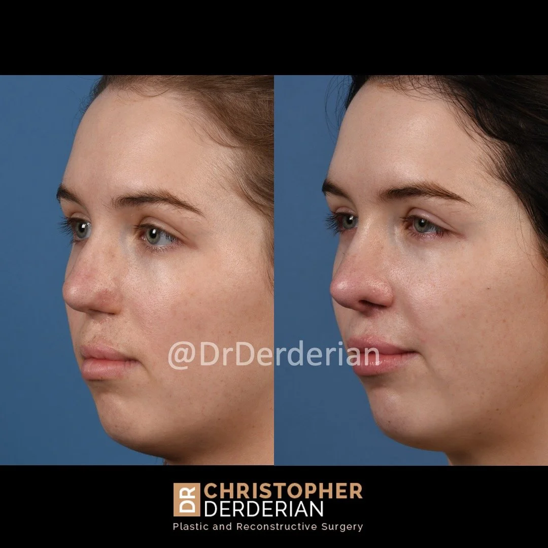 Cleft Rhinoplasty — Dr Derderian — Plastic and Reconstructive Surgery