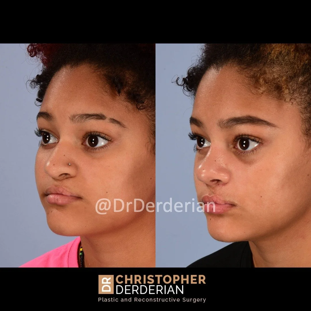 Cleft Rhinoplasty — Dr Derderian — Plastic and Reconstructive Surgery