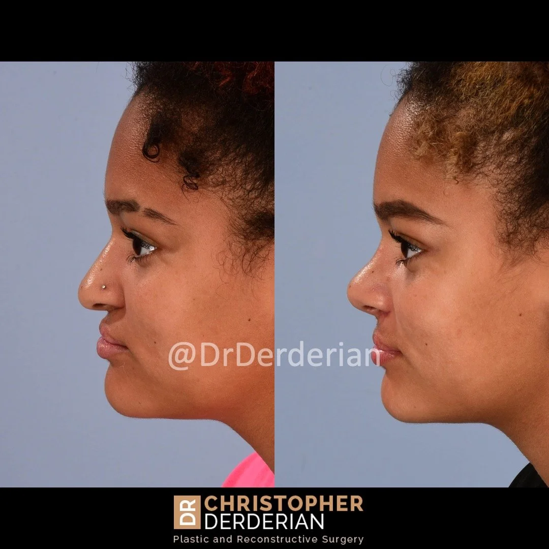 Cleft Rhinoplasty — Dr Derderian — Plastic And Reconstructive Surgery