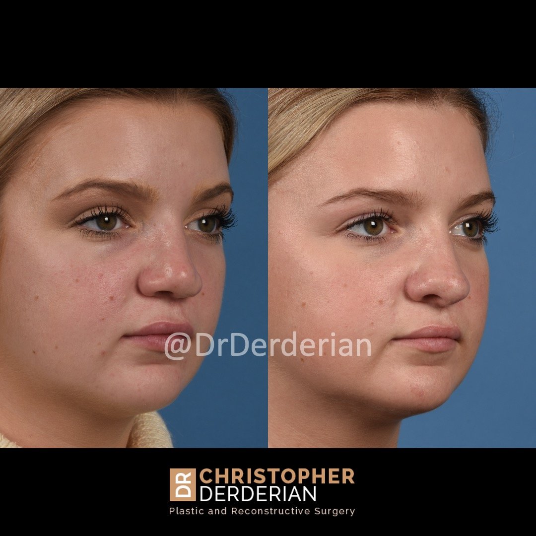 Cleft Rhinoplasty — Dr Derderian — Plastic and Reconstructive Surgery