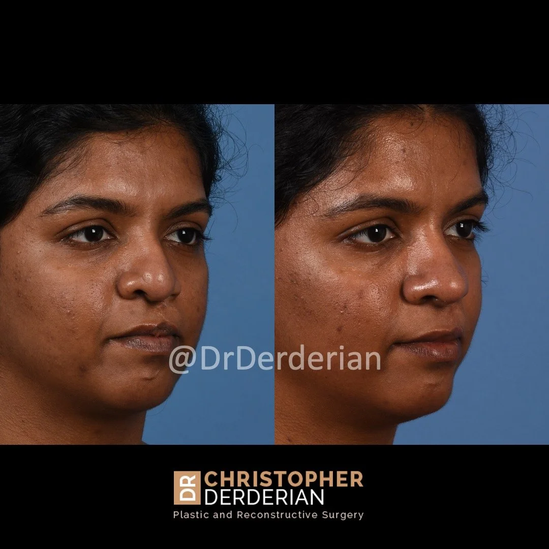 Adult Cleft Rhinoplasty & Cleft Lip Revision — Dr Derderian — Plastic ...