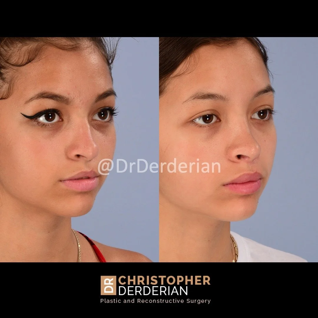 Cleft Rhinoplasty — Dr Derderian — Plastic and Reconstructive Surgery