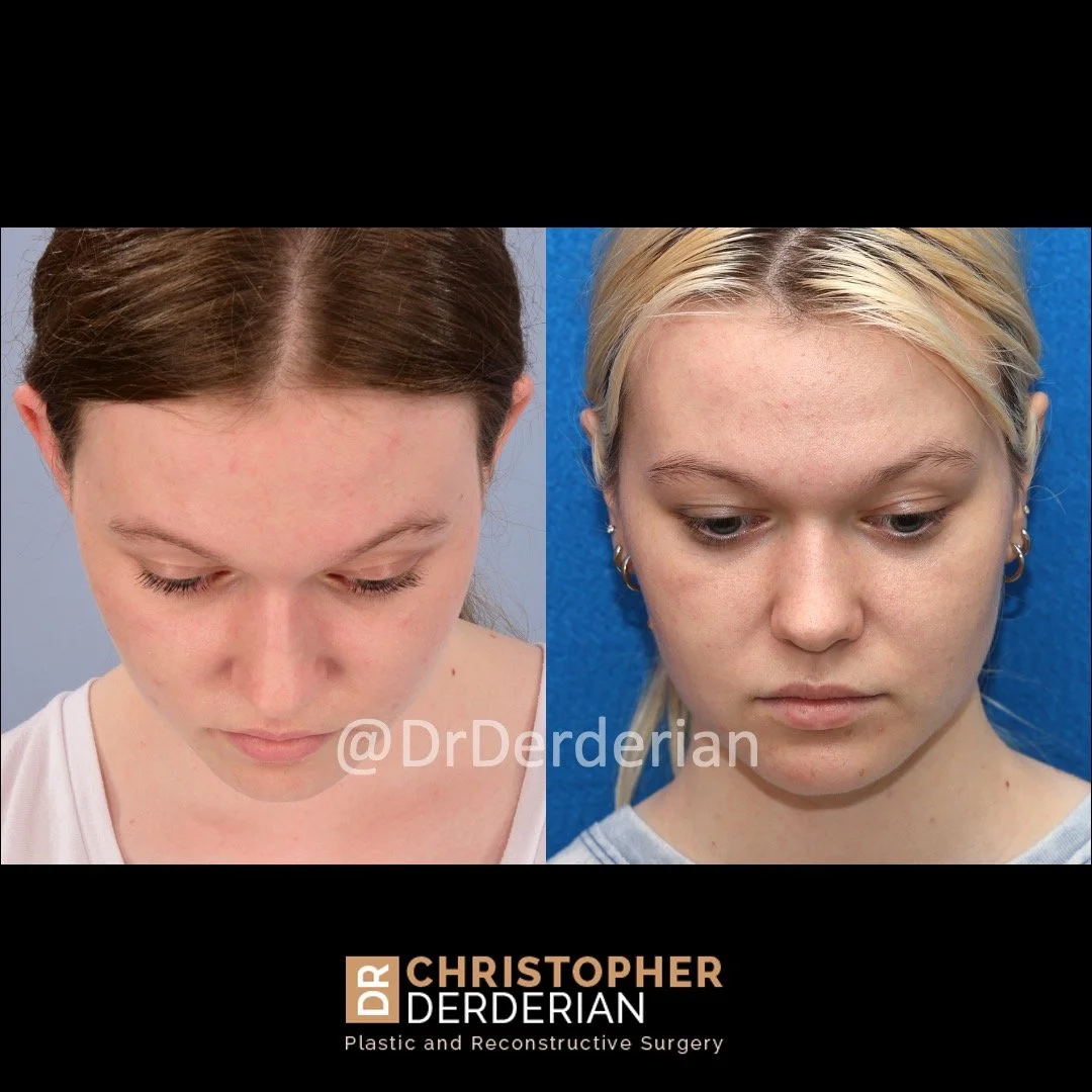 Otoplasty Surgery And Ear Pinning Near Me Dallas Texas Dr Derderian