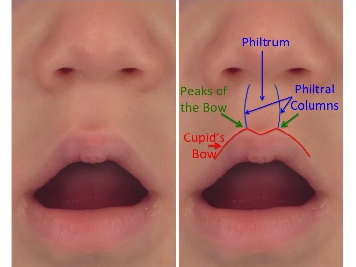 Cleft Lip Anatomy — Dr Derderian — Plastic and Reconstructive Surgery