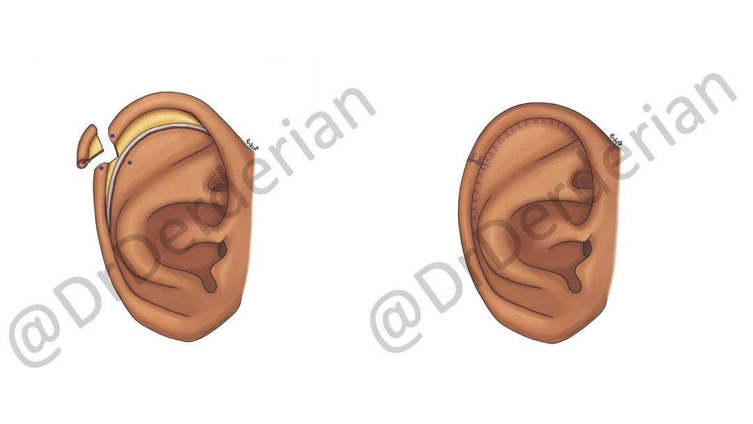 Reduction Otoplasty — Dr Derderian — Plastic and Reconstructive Surgery
