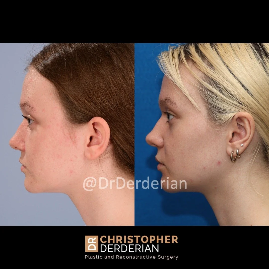 Otoplasty Surgery And Ear Pinning Near Me Dallas Texas Dr Derderian