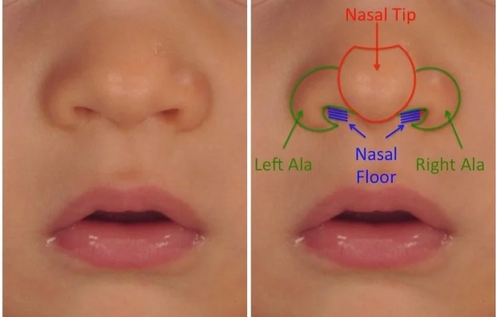 Cleft Nasal Anatomy — Dr Derderian — Plastic and Reconstructive Surgery