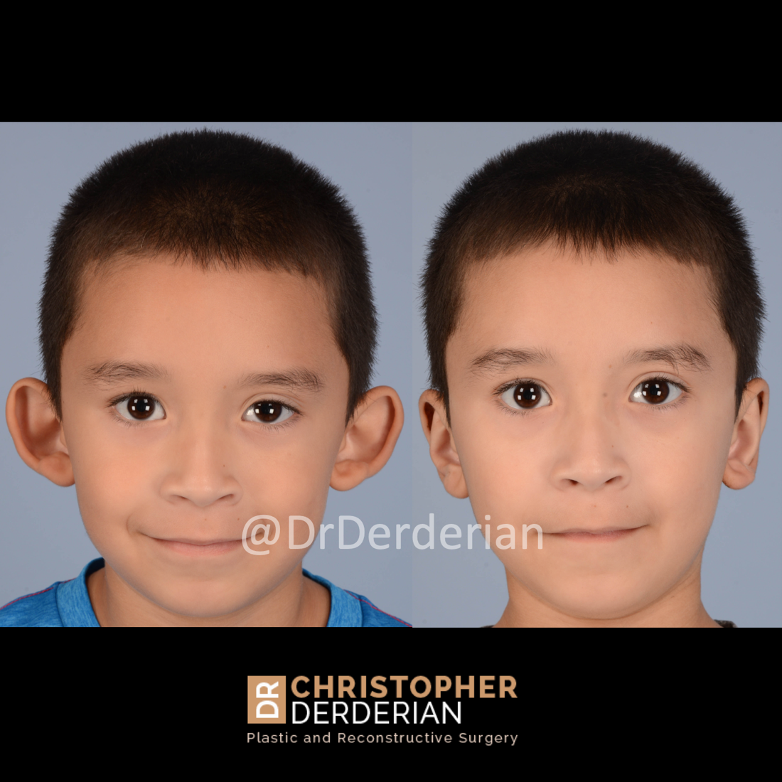 The Art of Natural-Looking Ears: Otoplasty Techniques and Results — Dr ...