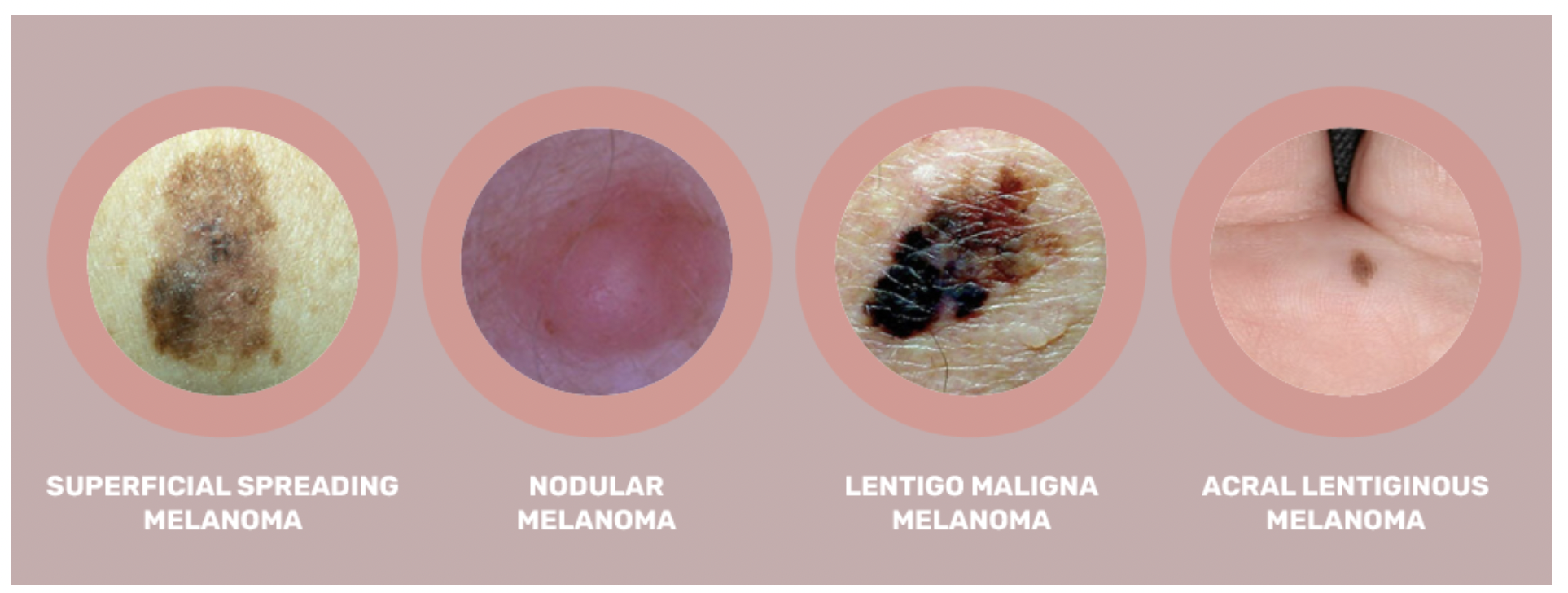 Melanoma risk is twice as high in Parkinson's: A call to counsel every ...