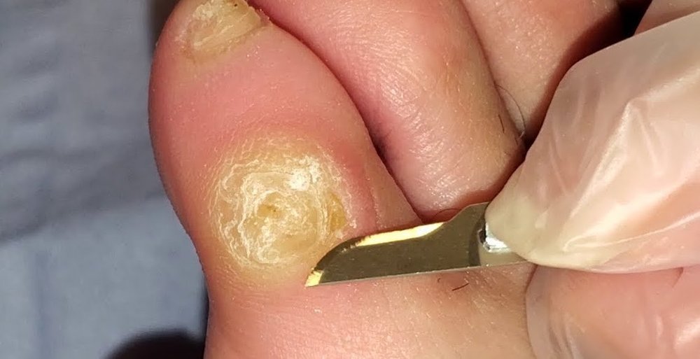 Bridgend South Wales Chiropodist Podiatrist Foot Health Foot Care Corn ...