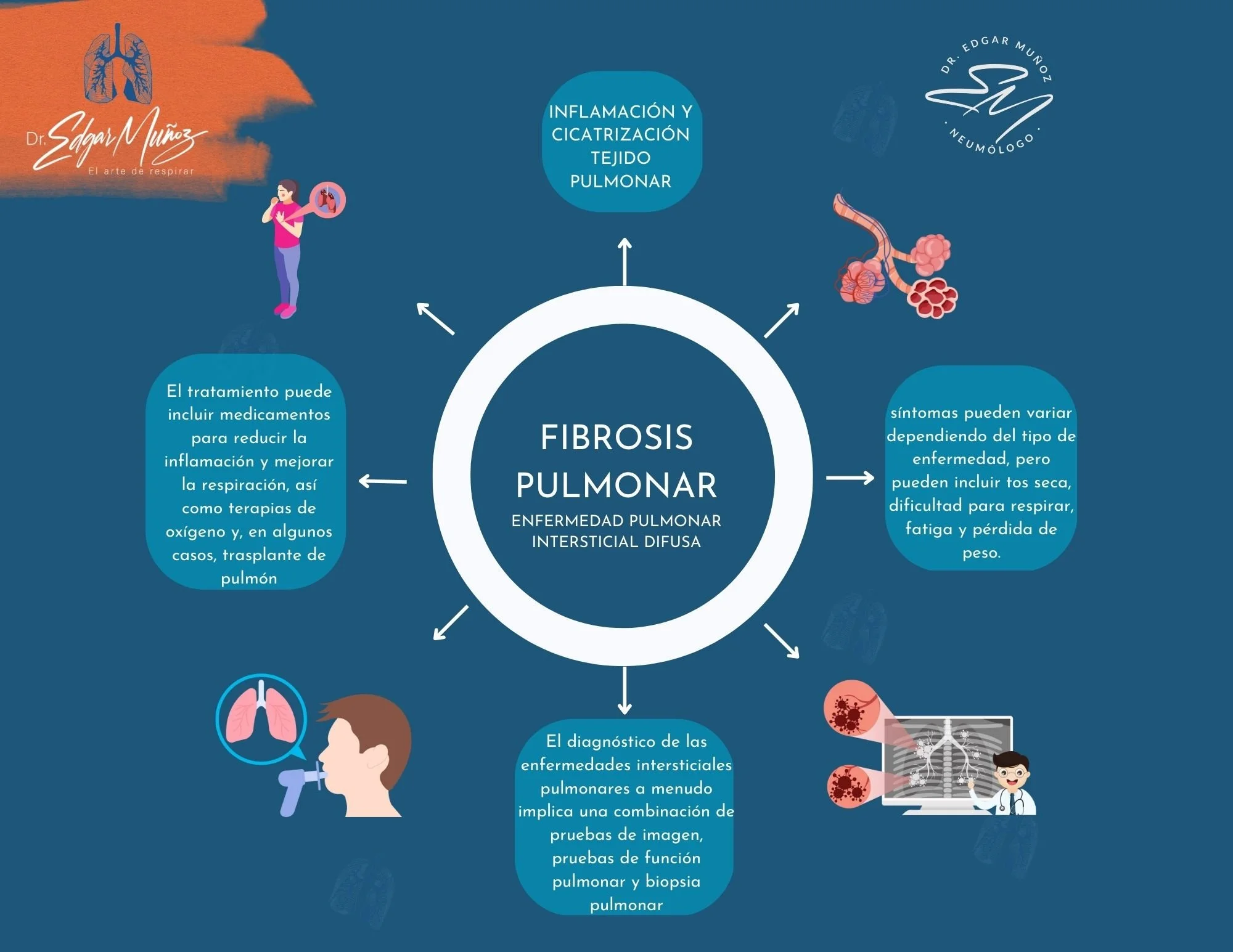 Fibrosis Pulmonar: Diagnóstico Temprano y Tratamientos Eficaces