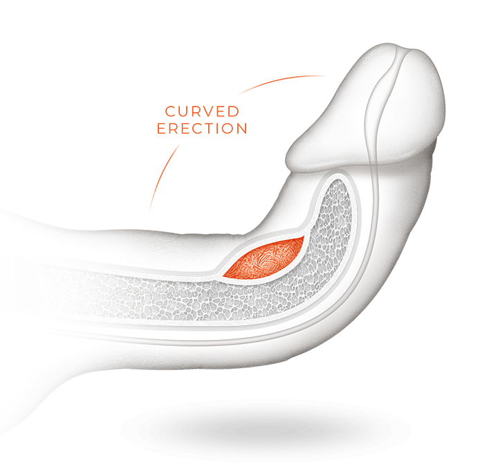 Treatpeyronies