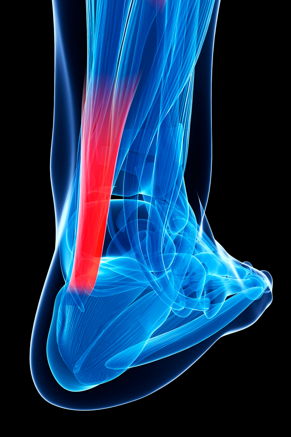 Achilles Tendinopathy: Learn More About this Common Running Injury ...