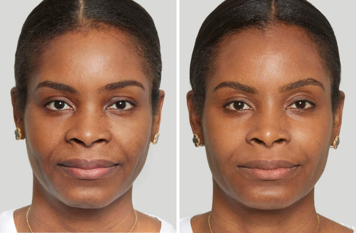 Sculptra — REN Rejuvenation Bar