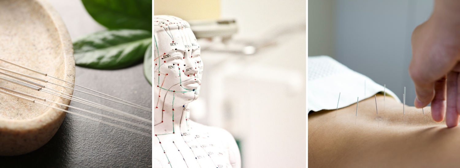Acupuncture | Experience Natural Relief — Strathpine GP Superclinic