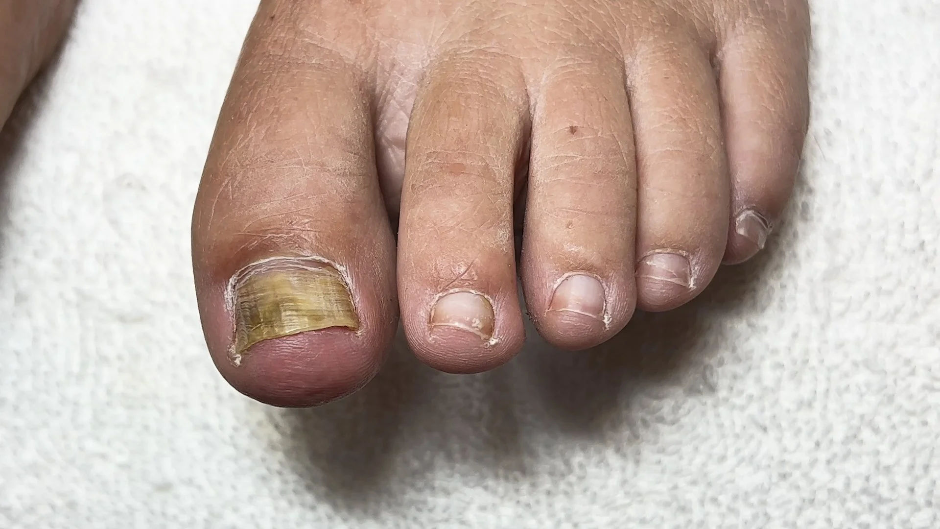 How to Help a Toenail Reattach — Meticulous Manicurist