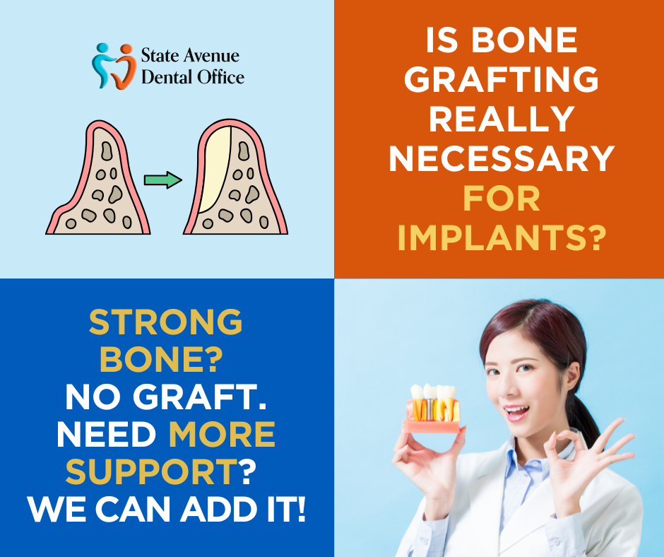 Does Bone Grafting Matter for Dental Implants in Kansas City? — State ...
