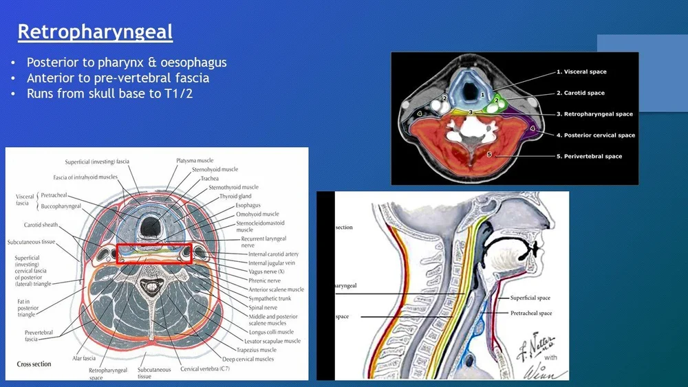 Retropharyngeal Abscess Diagram