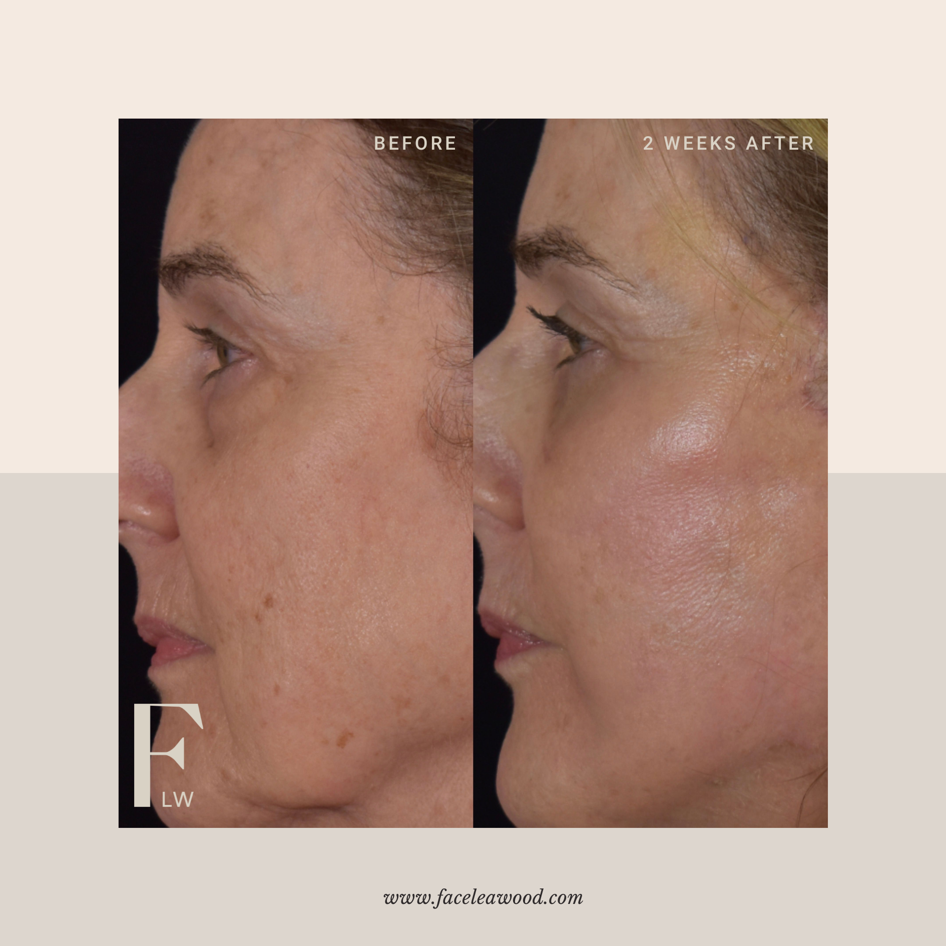 Medical Grade Chemical Peel — FACE Leawood