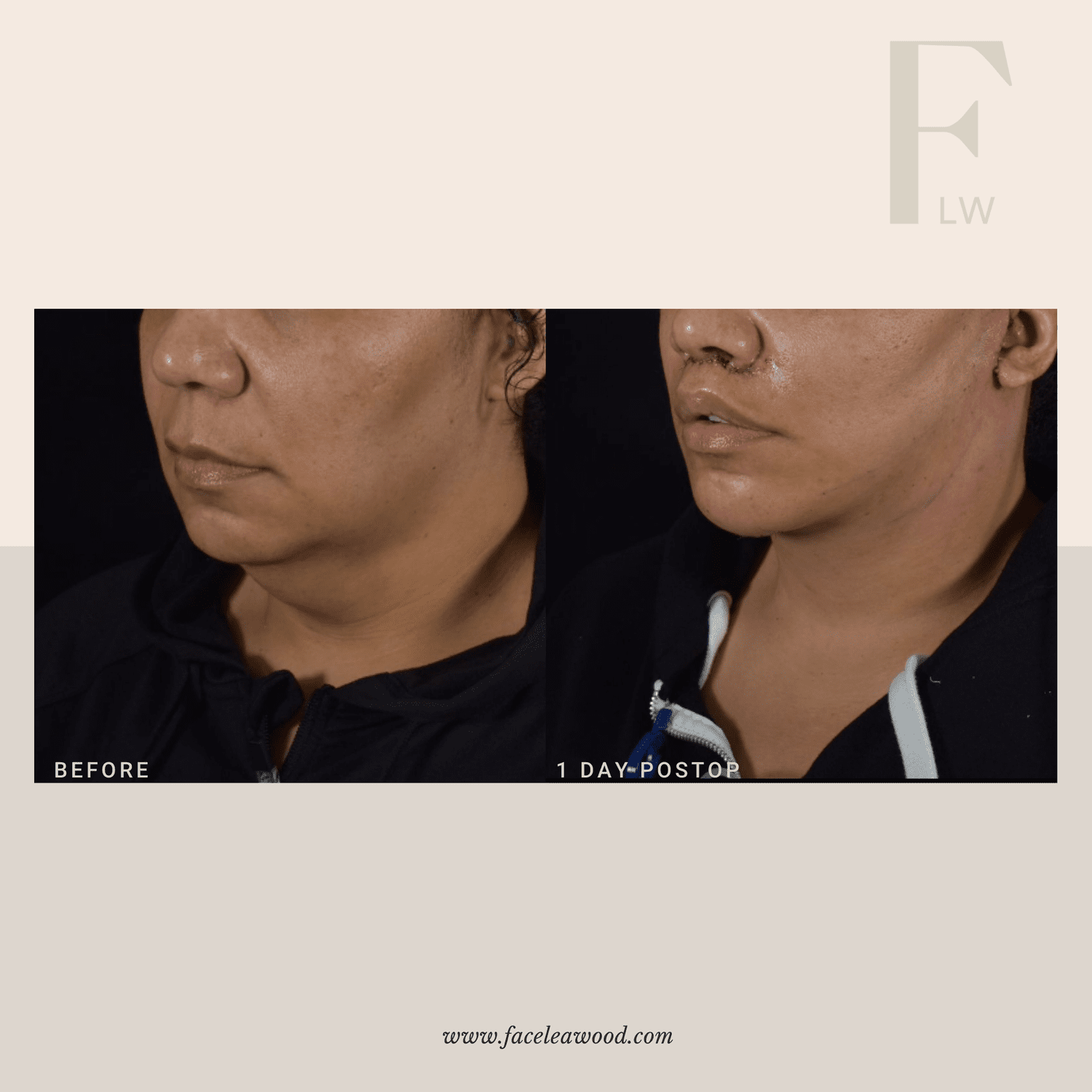 Lip Lift Kansas City — FACE Leawood