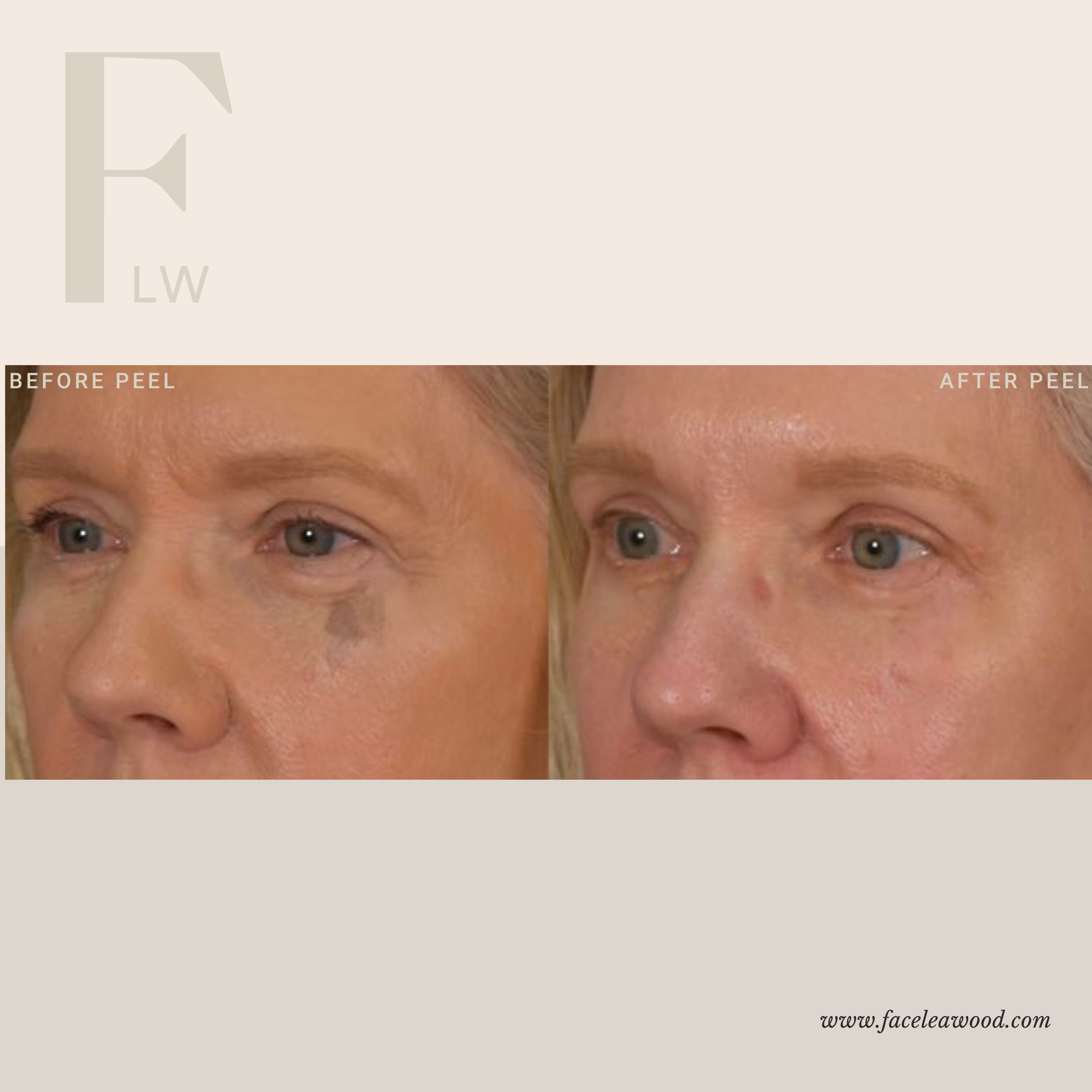 Medical Grade Chemical Peel — FACE Leawood