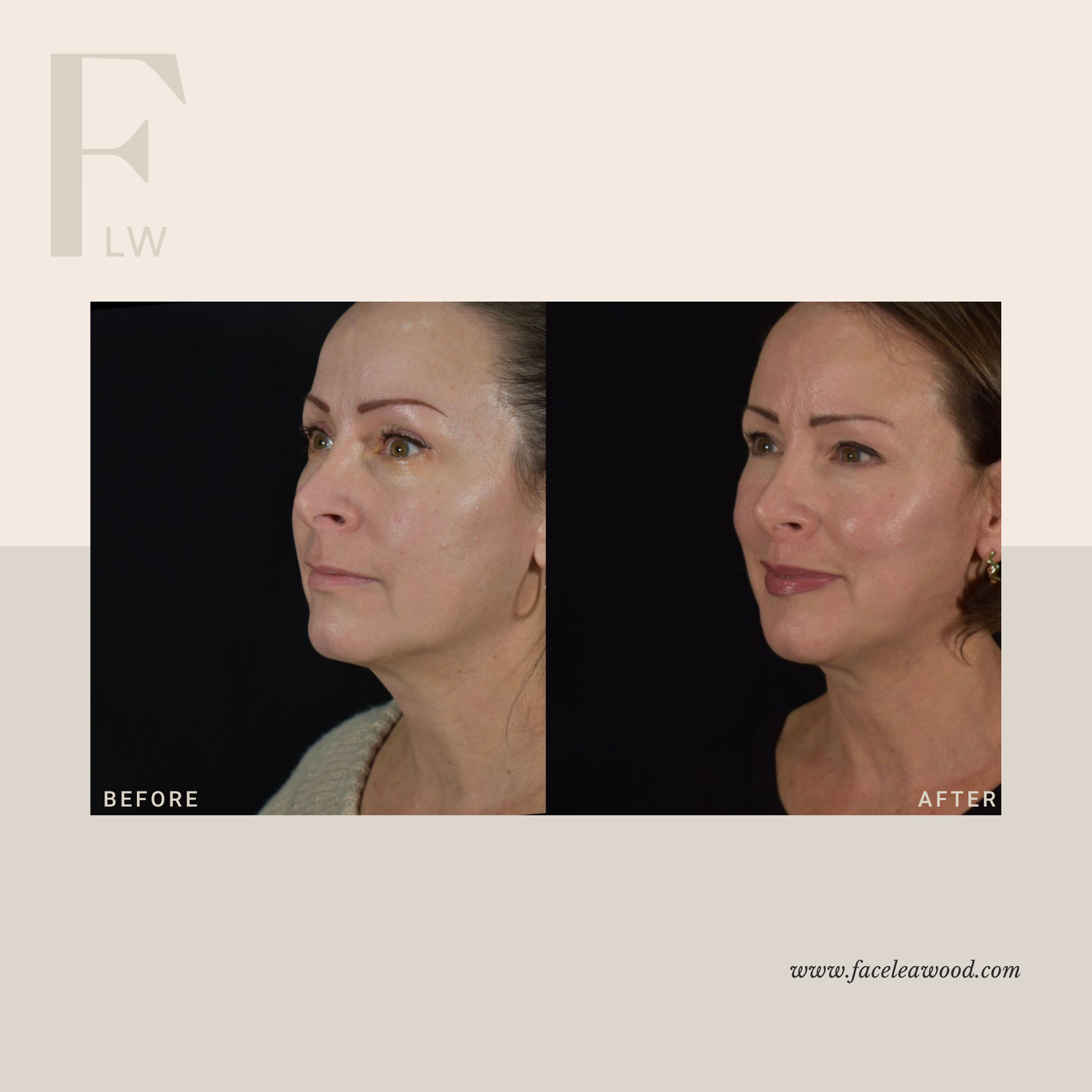 Lip Lift Kansas City — FACE Leawood