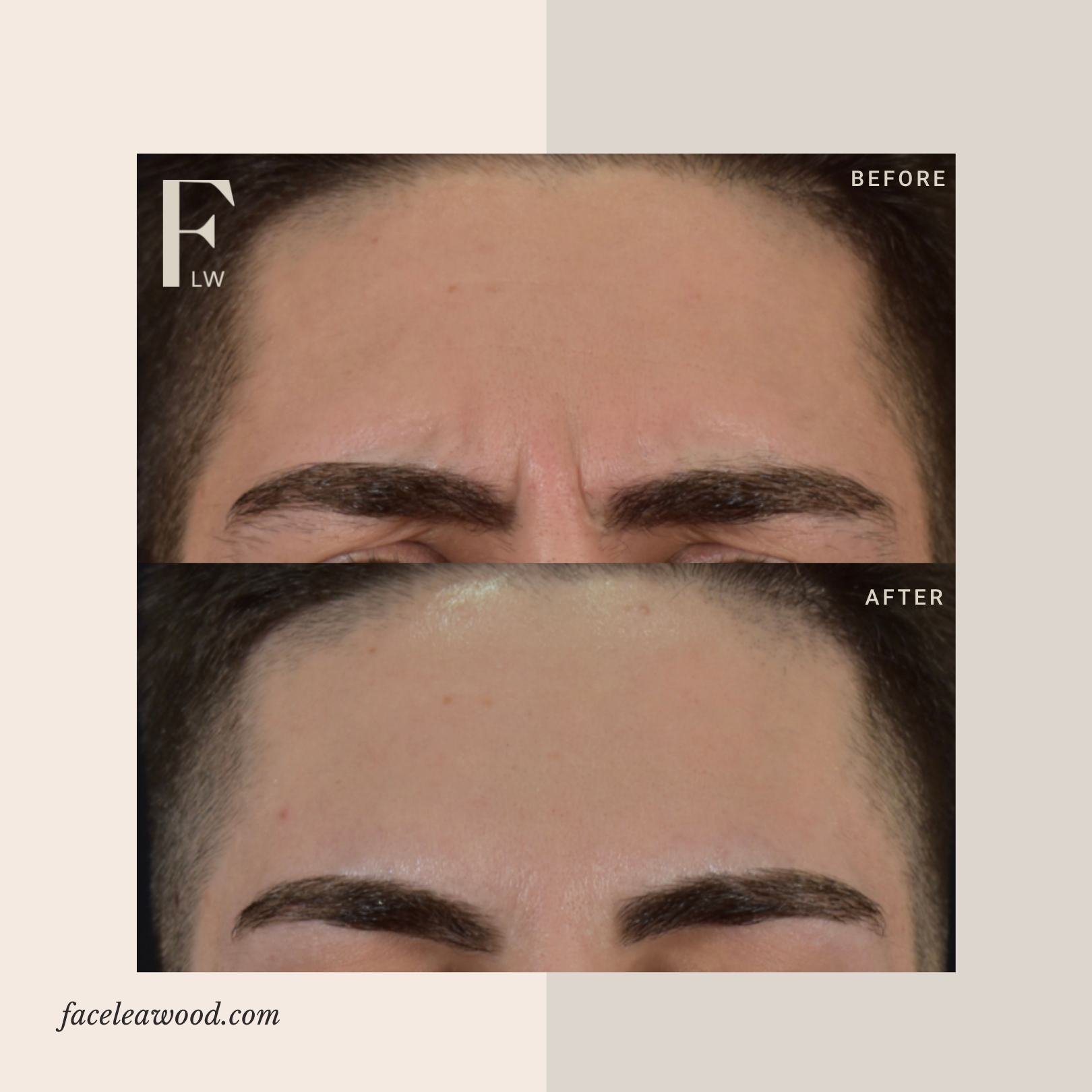 Botox Kansas City — FACE Leawood