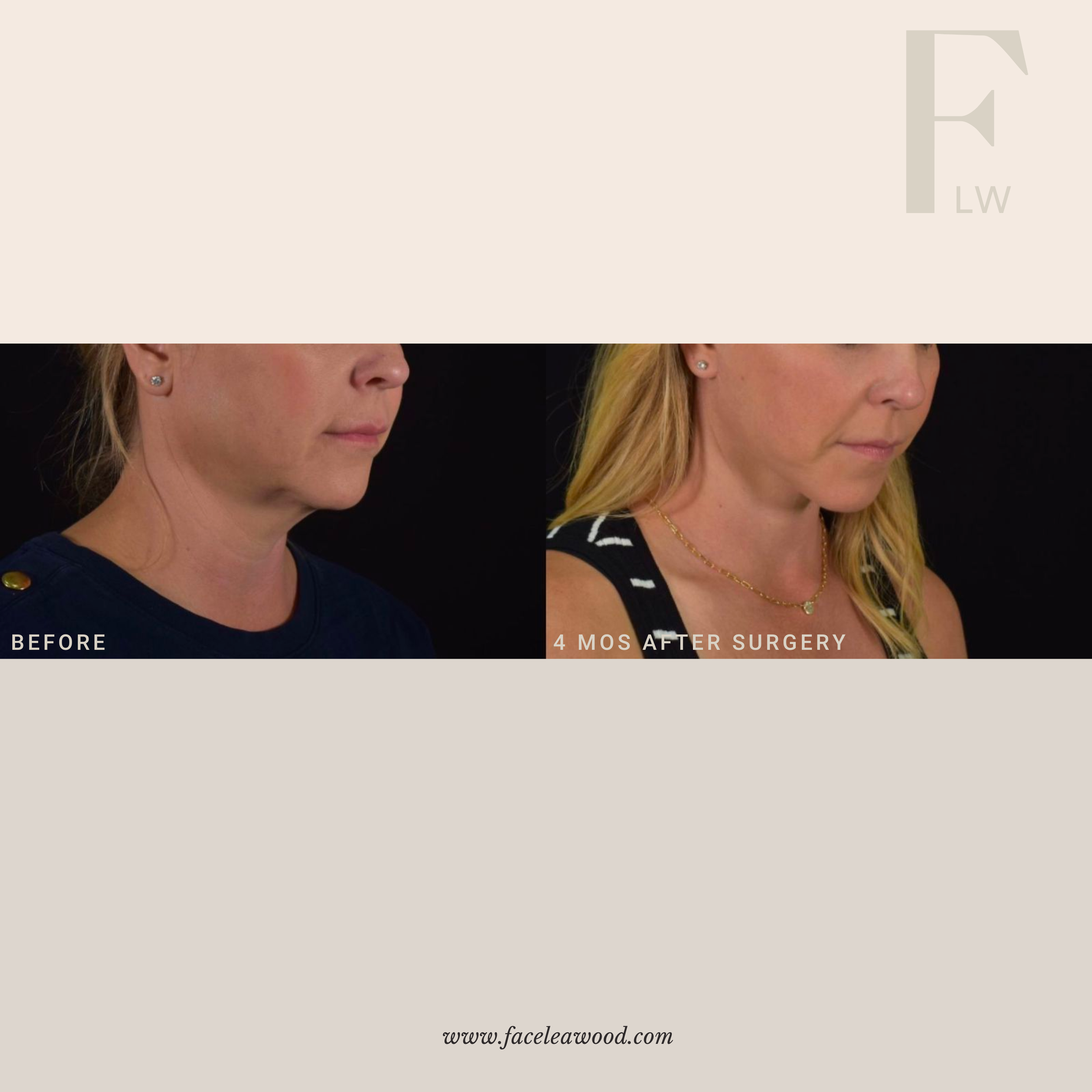 Neck Lift Kansas City — FACE Leawood