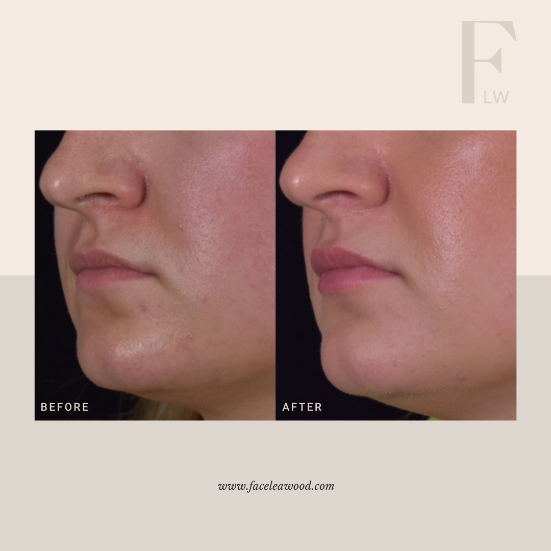 Filler Kansas City — FACE Leawood