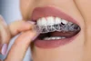 Clear Teeth Aligners | Grants Ferry Family Dentistry