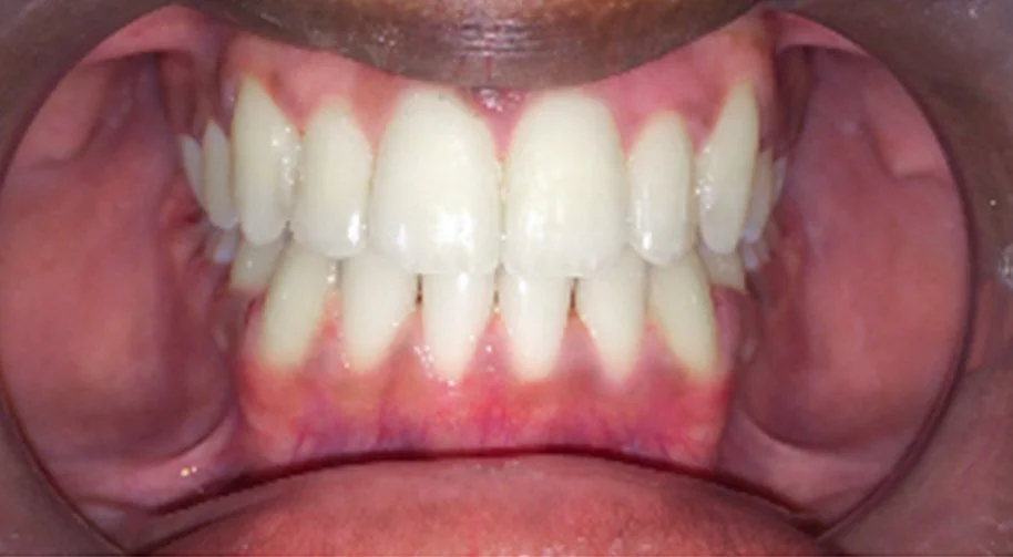 Before and After — Frankowitz Orthodontics