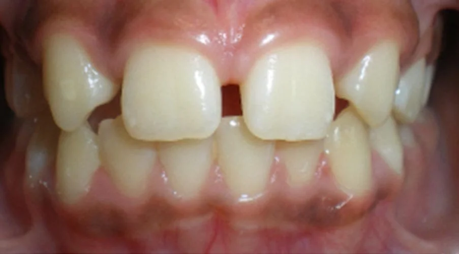 Before and After — Frankowitz Orthodontics