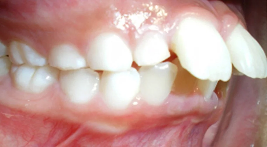 Before and After — Frankowitz Orthodontics