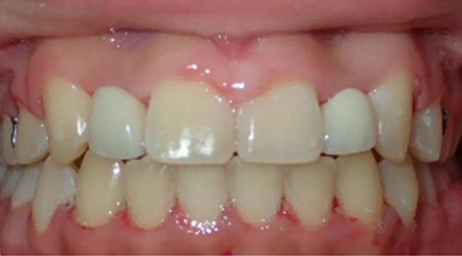 Before and After — Frankowitz Orthodontics