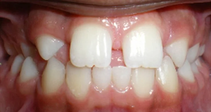 Before and After — Frankowitz Orthodontics