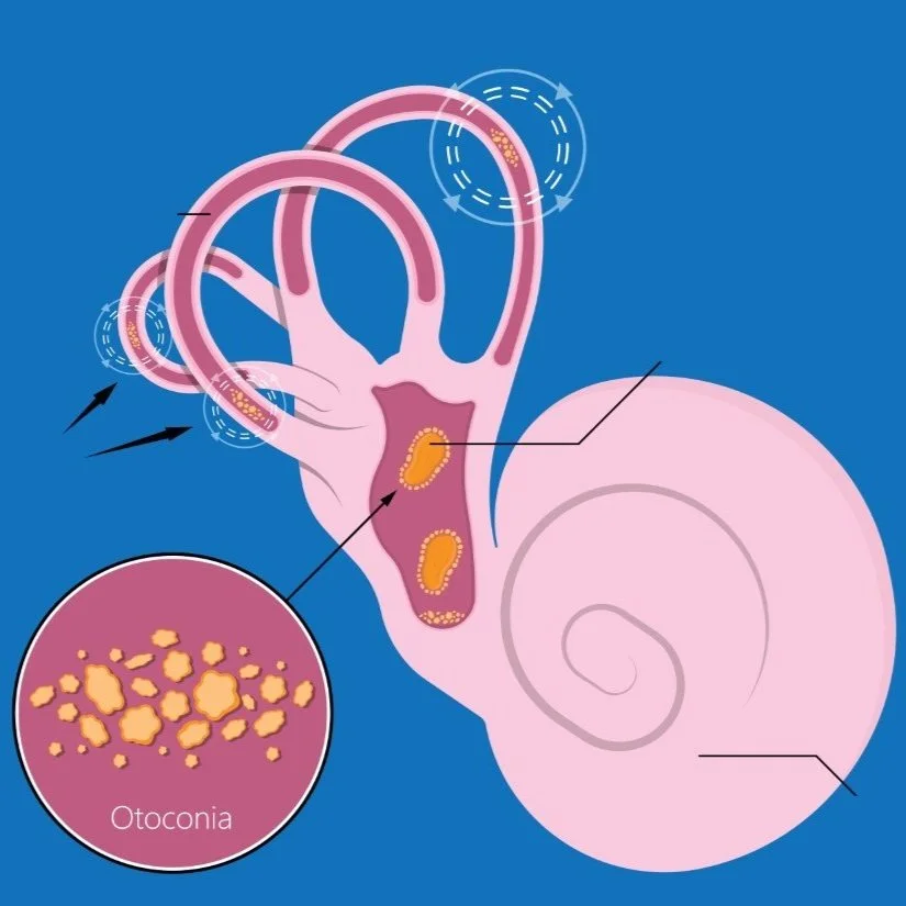 Vestibular Conditions — Equilibrium Rehab