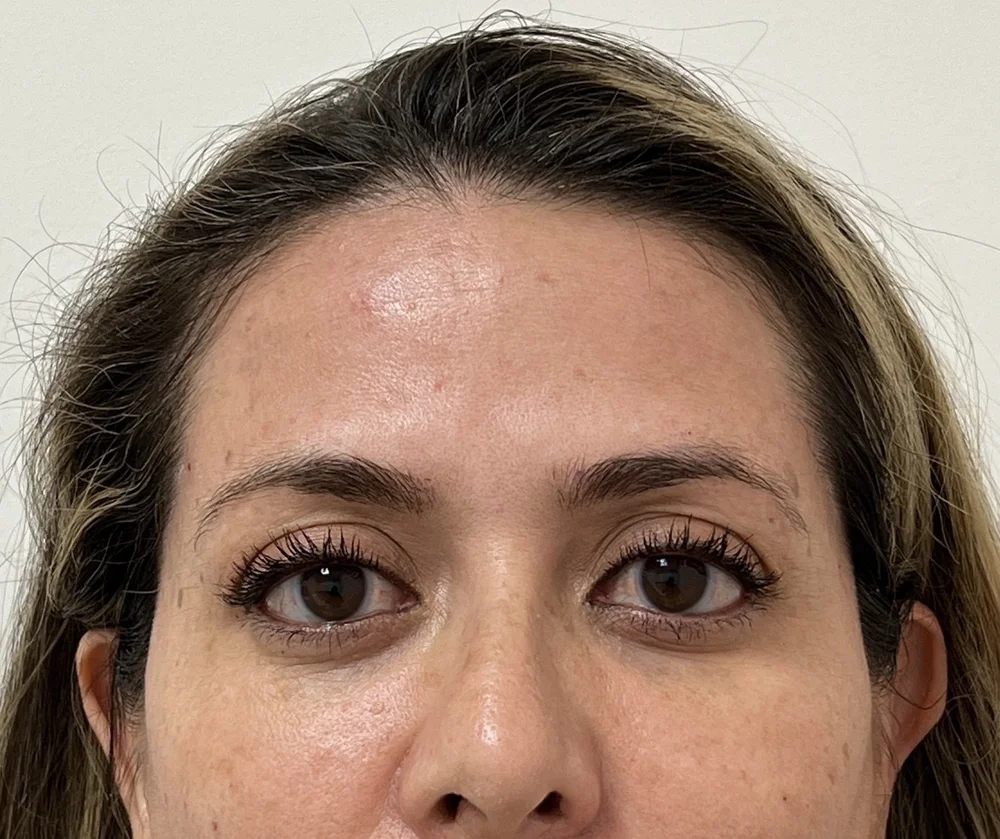 Temple Filler Treatment in Redondo Beach, CA — Beauty Cult