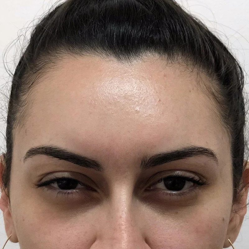 Botox Injection Treatment in Redondo Beach, CA — Beauty Cult