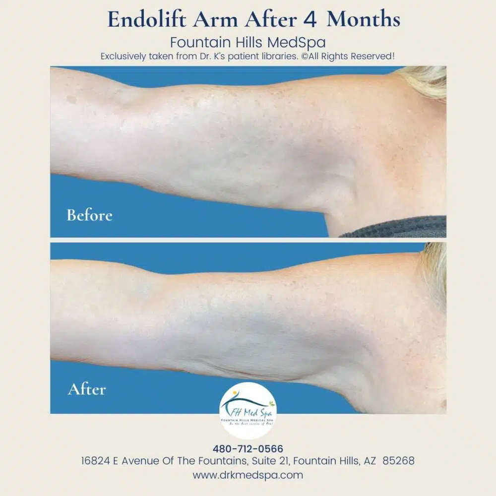 Laser Skin Tightening in Redondo Beach | EndoLift Laser — Beauty Cult
